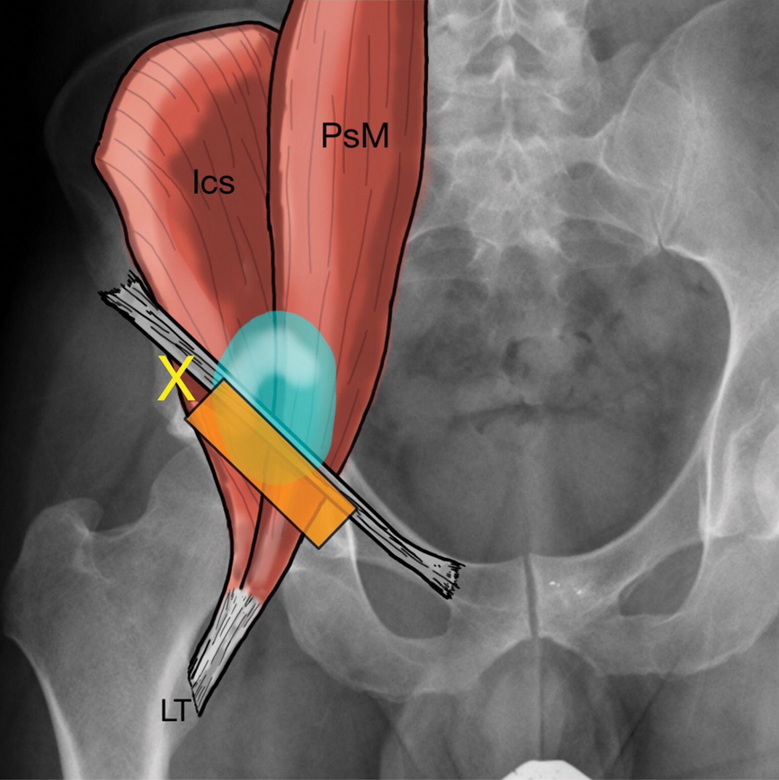 Comprendre et Soulager la Tendinite du Psoas : Guide Complet – KineForce
